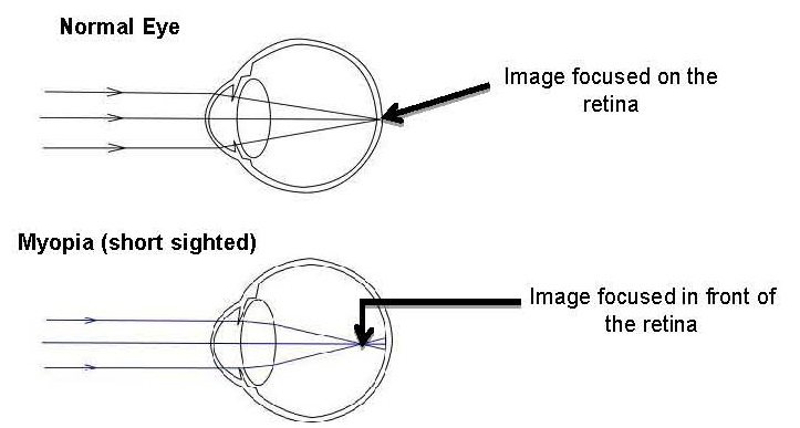 Myopia - Mata Clinic & Optometrist Blog