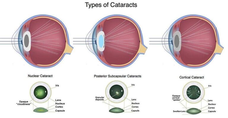 Patient Education Series: Posterior Subcapsular (PSC) Cataract - Mata ...